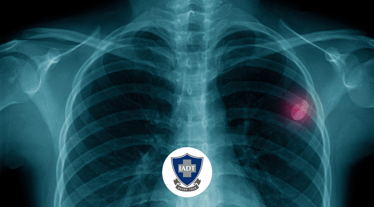 Marcapasos cardíaco | Cómo se coloca y la cirugía ambulatoria - IADT